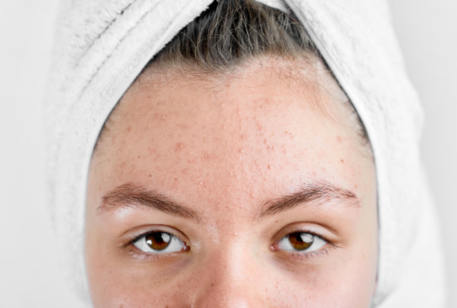 Oily & Acne Skin