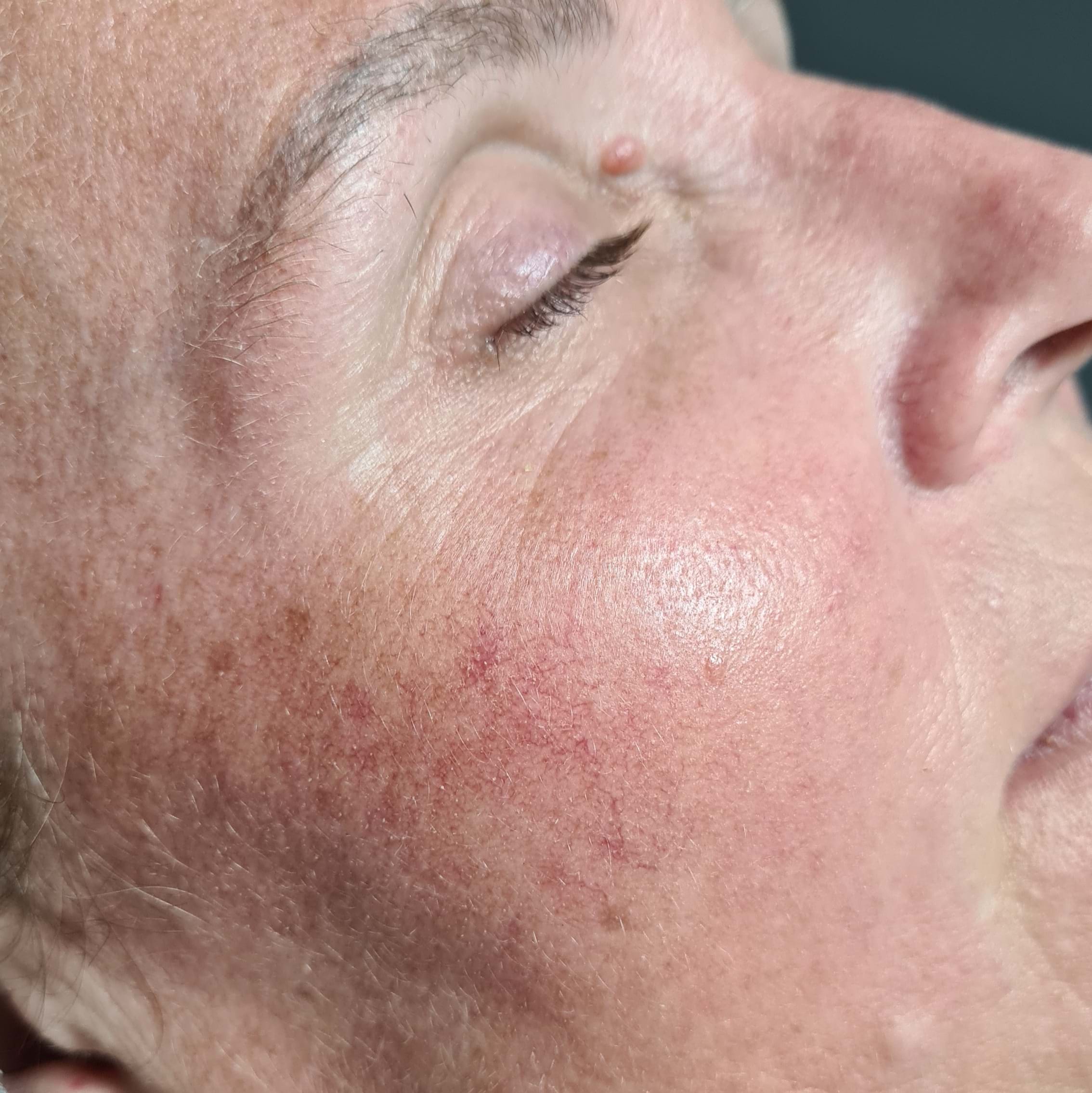 Sensitive Delicate Facials